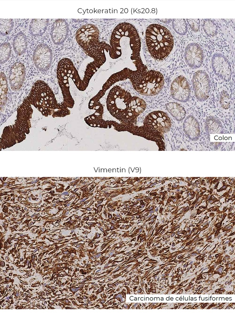Diferenciación Tumoral | BIO-OPTIC S.R.L.